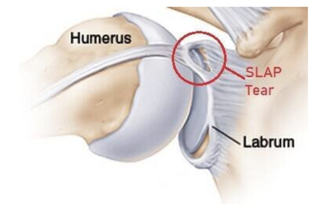 Shoulder Labral Tears Eastside Medical Group Cleveland Ohio